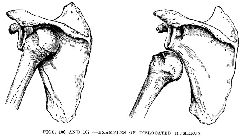 How to Tell If You Have A Dislocated Shoulder